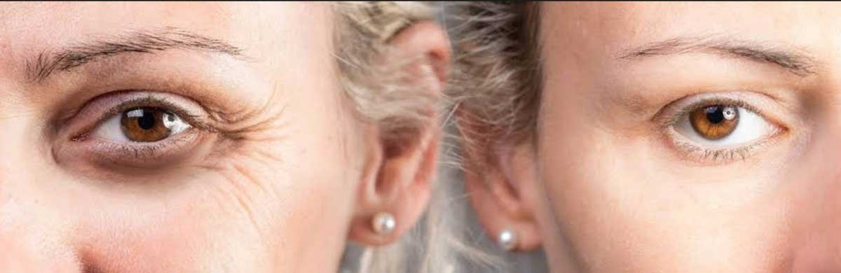 Understanding the Short and Long Term Effects of Botox - greenecodream.com